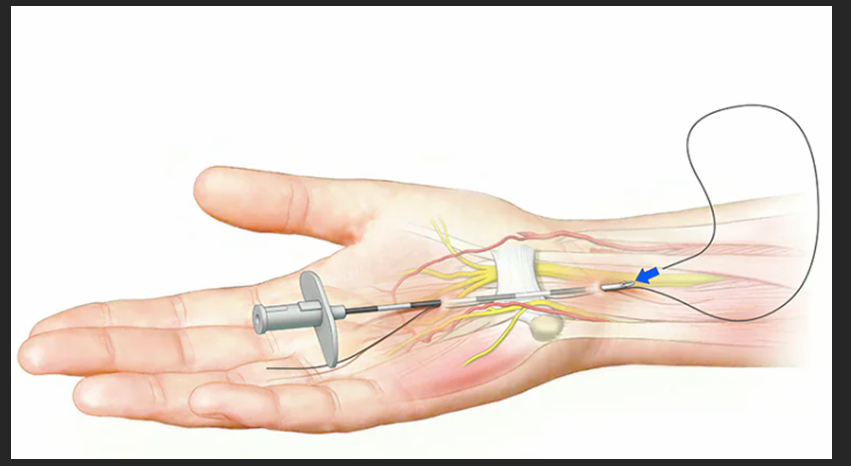 آشنایی با بیماری تنگی کانال کارپال یا CTS – کلینیک فیزیوتراپی دکتر صادقی