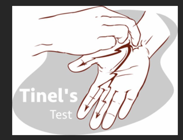 آشنایی با بیماری تنگی کانال کارپال یا CTS – کلینیک فیزیوتراپی دکتر صادقی