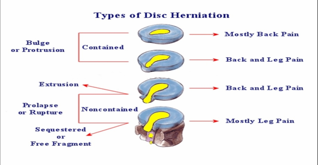 مراحل بیرون زدگی دیسک – کلینیک فیزیوتراپی دکتر صادقی